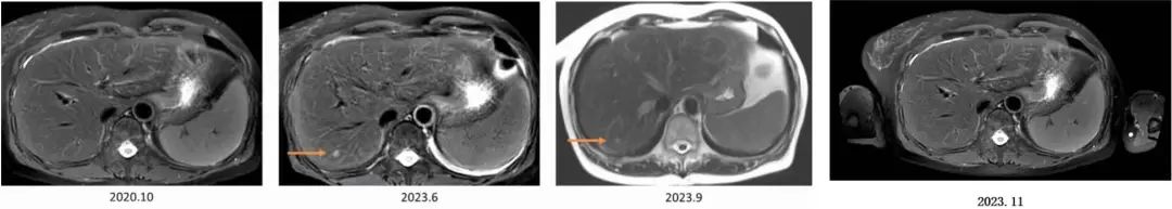 优效便捷——PFS达3年，长春瑞滨+卡培他滨（NX方案）双口服联合治疗，有效延长乳腺癌肝转移患者生存期医药新闻-ByDrug-一站式医药资源共享中心-医药魔方