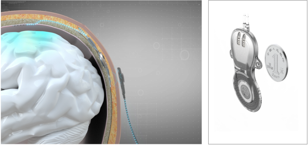 博睿康无线微创植入脑机接口NEO迎来突破性进展，四肢截瘫患者通过植入实现自主脑控喝水| 松禾Portfolio医药新闻-ByDrug-一站式医药资源共享中心-医药魔方