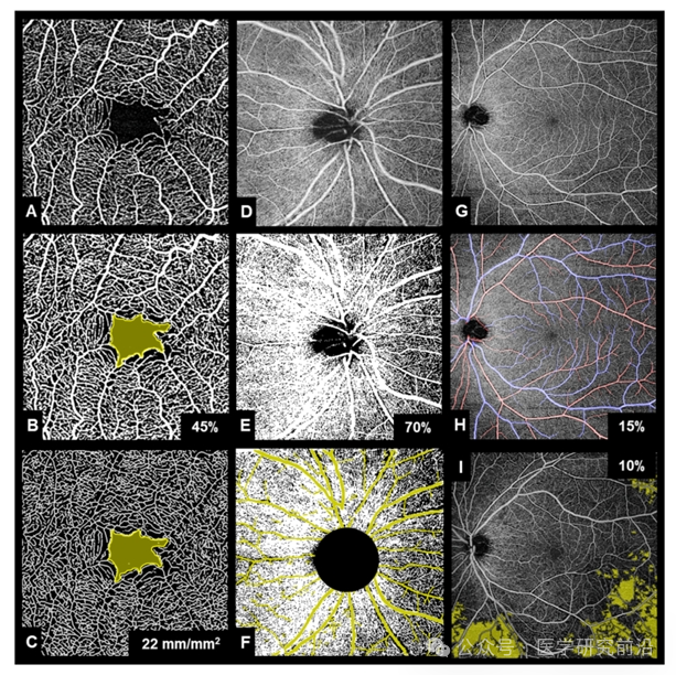 Prog. Retin. Eye Res.重磅综述！告别传统！OCTA眼科血管成像精准诊断系统性疾病，但挑战依然存在！医药新闻-ByDrug-一站式医药资源共享中心-医药魔方