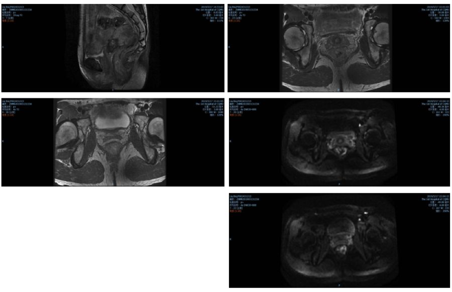 开卷有“益”|拓享新生——特瑞普利单抗治疗MSI-H直肠腺癌5周期达临床完全缓解医药新闻-ByDrug-一站式医药资源共享中心-医药魔方