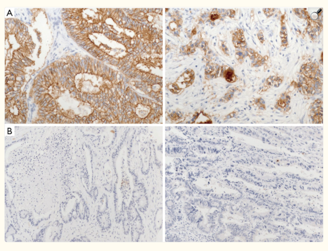 Claudin 18.2系列之一，多种实体肿瘤可受益于这个新靶点的抗癌药，这次点名双抗药QLS31905！医药新闻-ByDrug-一站式医药 ...