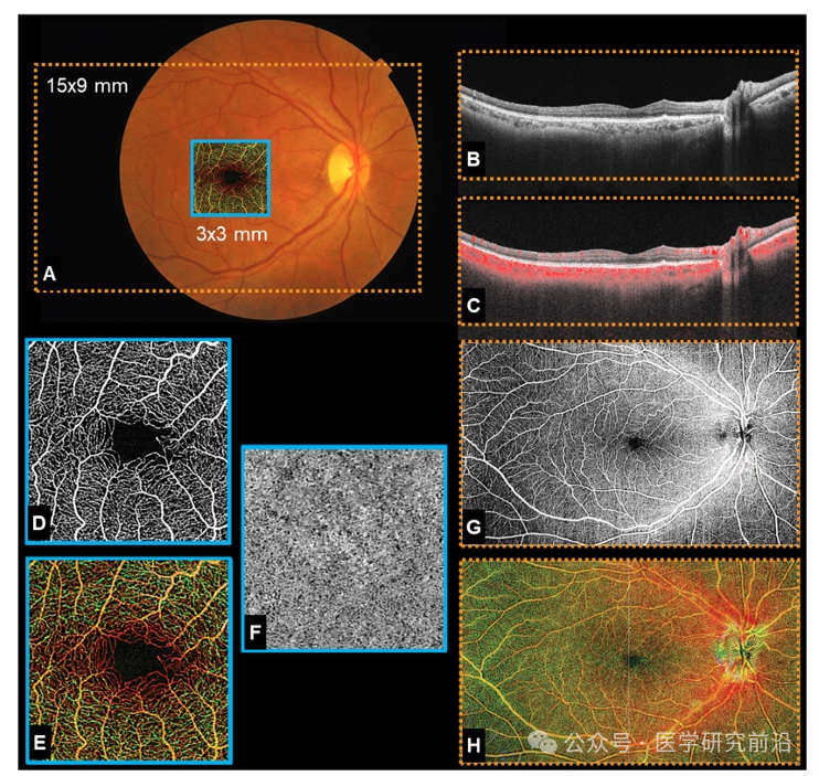 Prog. Retin. Eye Res.重磅综述！告别传统！OCTA眼科血管成像精准诊断系统性疾病，但挑战依然存在！医药新闻-ByDrug-一站式医药资源共享中心-医药魔方