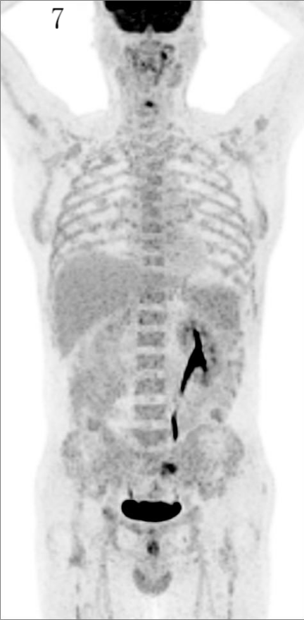FAPI-PET/CT：精准捕捉腹膜转移癌的“神探”医药新闻-ByDrug-一站式医药资源共享中心-医药魔方