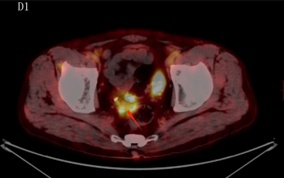 FAPI-PET/CT：精准捕捉腹膜转移癌的“神探”医药新闻-ByDrug-一站式医药资源共享中心-医药魔方