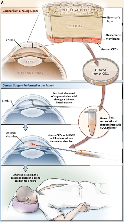 全球首个获批用于眼病的通用型细胞疗法正式推出医药新闻-ByDrug-一站式医药资源共享中心-医药魔方