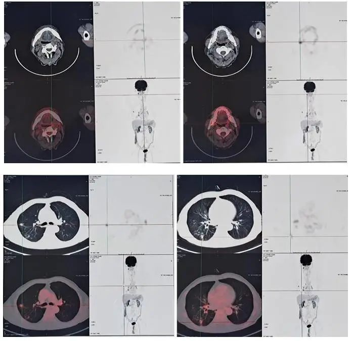 【颈彩纷呈】局部晚期下咽鳞状细胞癌病例浅析，MDT启发临床实践与治疗探索医药新闻-ByDrug-一站式医药资源共享中心-医药魔方