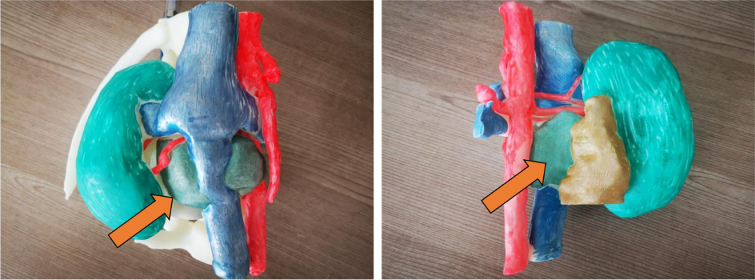 “3D打印”携手“达芬奇”机器人，助力泌尿外科“精准摘瘤”医药新闻-ByDrug-一站式医药资源共享中心-医药魔方