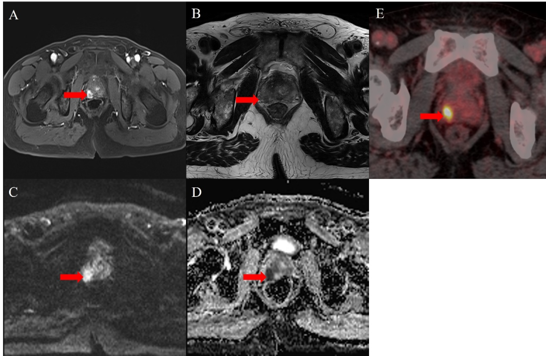 特异性诊断前列腺癌新 “雷达”——PSMA PET显像医药新闻-ByDrug-一站式医药资源共享中心-医药魔方