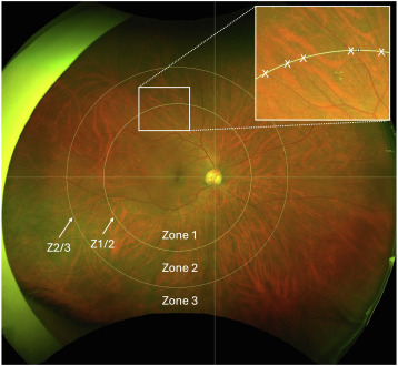 最新研究：OCTA影像揭示视网膜色素变性患者周边视网膜血管缺失医药新闻-ByDrug-一站式医药资源共享中心-医药魔方