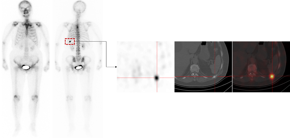 “一站式”诊断骨转移——全身骨SPECT/CT显像医药新闻-ByDrug-一站式医药资源共享中心-医药魔方