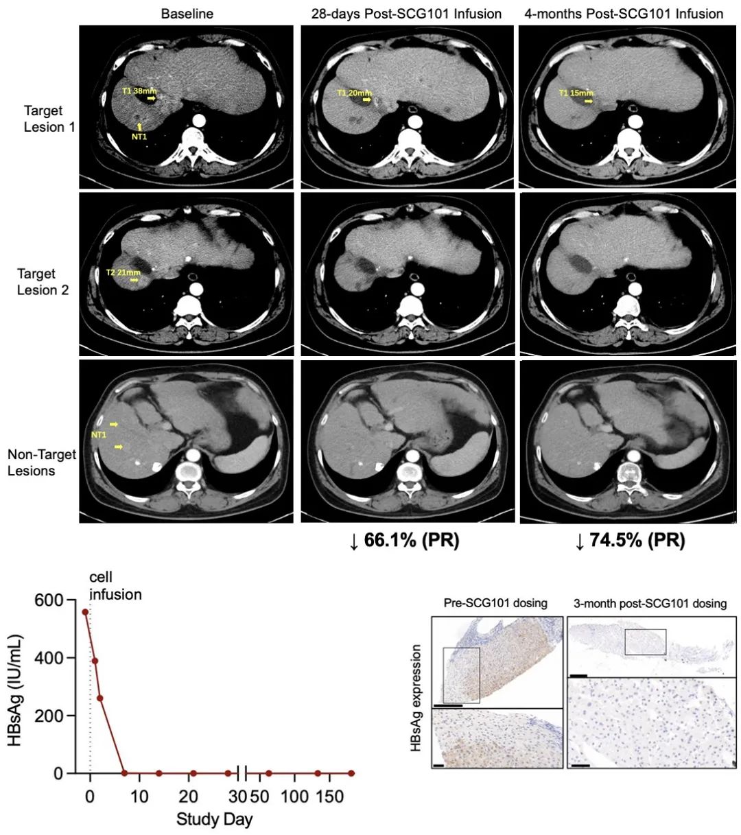 ASCO2023丨SCG101双管齐下，治疗晚期HBV-HCC显示出抗肿瘤和抗病毒活性医药新闻-ByDrug-一站式医药资源共享中心-医药魔方