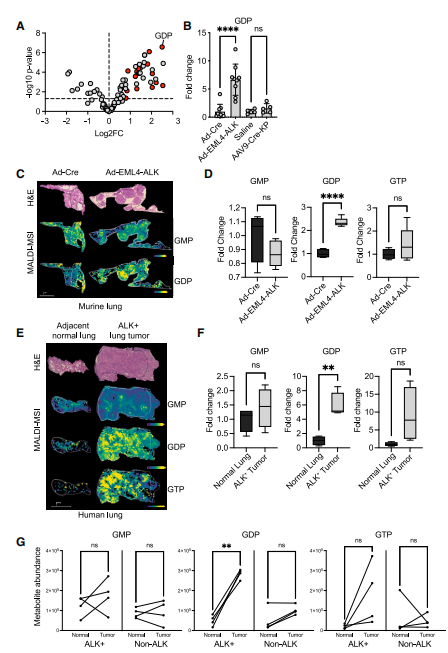 【学术前沿】ALK驱动的GUK1磷酸化调控鸟嘌呤核苷酸代谢促进肺癌生长的机制研究医药新闻-ByDrug-一站式医药资源共享中心-医药魔方