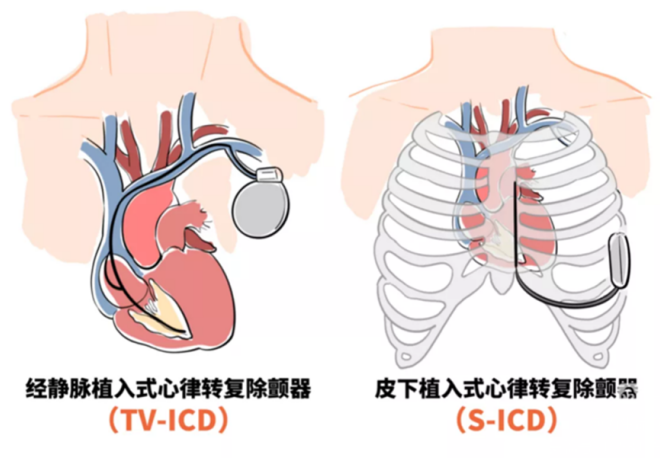 上海首例！为衰弱心脏装上“双保险”！东方心内完成CCM+S-ICD一站式手术医药新闻-ByDrug-一站式医药资源共享中心-医药魔方