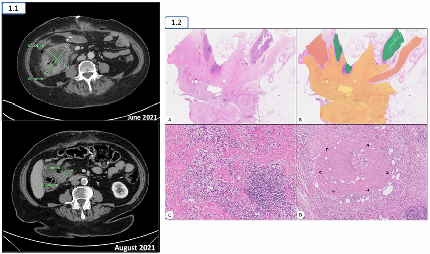 4例临床实例与进展梳理，探dMMR/MSI-H结直肠癌免疫转化治疗疗效与潜力医药新闻-ByDrug-一站式医药资源共享中心-医药魔方