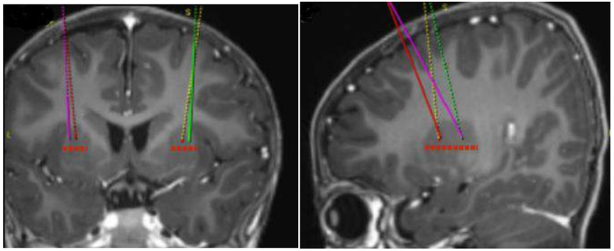 一文梳理│罕见病领域已上市AAV 疗法医药新闻-ByDrug-一站式医药资源共享中心-医药魔方