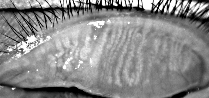 【光热脉动真实世界】MGD干眼：iLux 睑板腺光热脉动联合治疗效果显著医药新闻-ByDrug-一站式医药资源共享中心-医药魔方