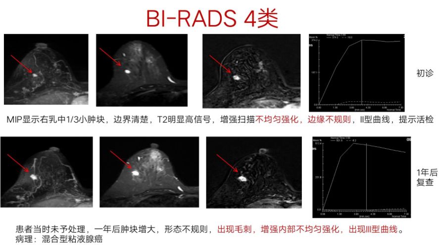 CSCO-BC︱周娟：乳腺磁共振的BI-RADS分类医药新闻-ByDrug-一站式医药资源共享中心-医药魔方