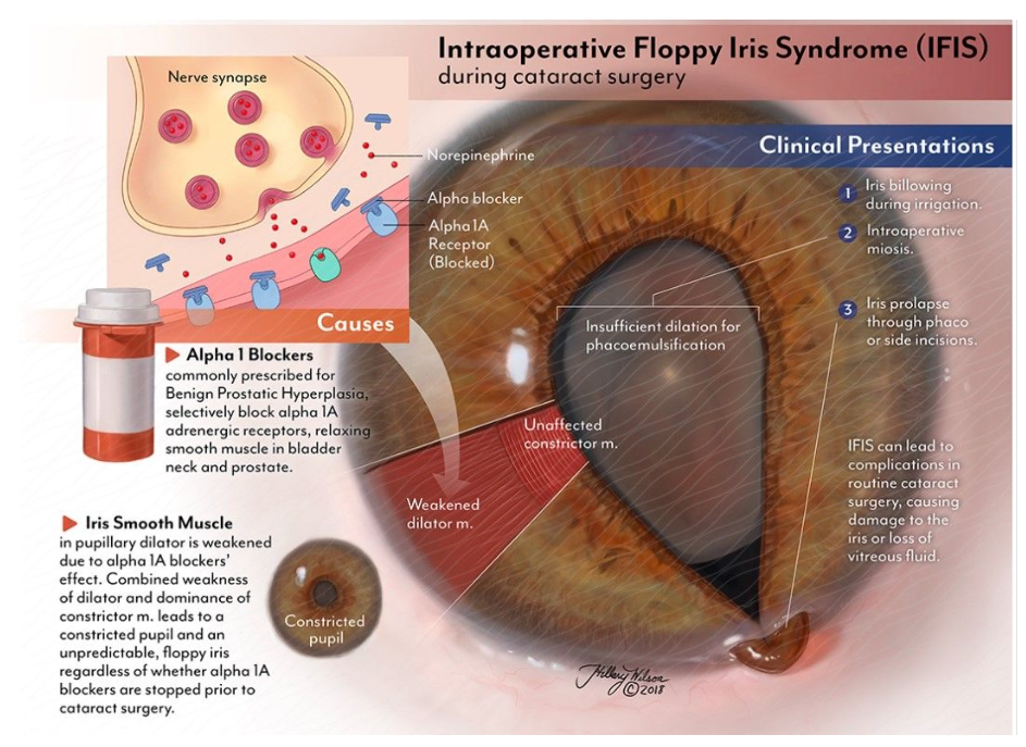 白内障术中虹膜松弛综合征（IFIS）相关药物关联新发现医药新闻-ByDrug-一站式医药资源共享中心-医药魔方