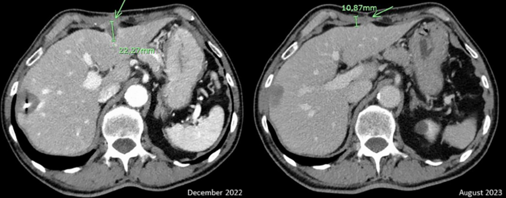 4例临床实例与进展梳理，探dMMR/MSI-H结直肠癌免疫转化治疗疗效与潜力医药新闻-ByDrug-一站式医药资源共享中心-医药魔方