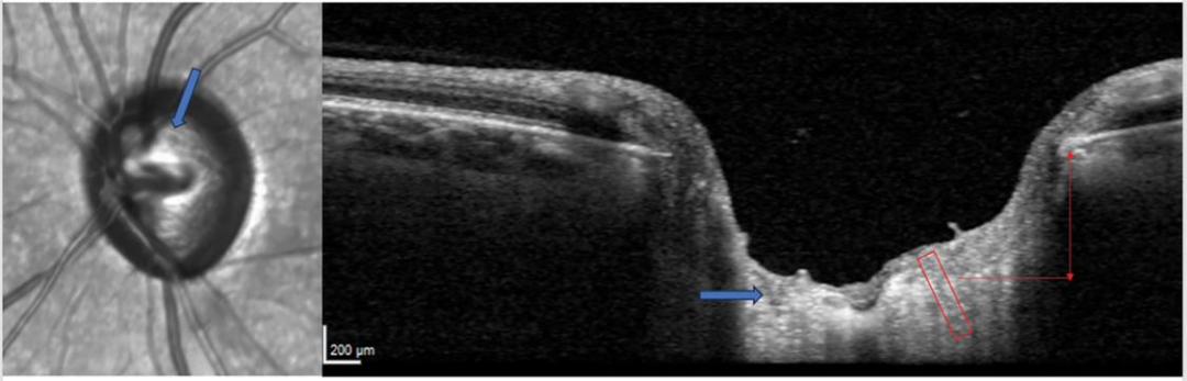 OCT生物标志物研究速览（一）：青光眼医药新闻-ByDrug-一站式医药资源共享中心-医药魔方