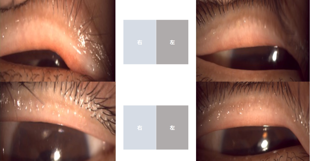 【光热脉动真实世界】光热脉动治疗3例典型MGD病例临床启示医药新闻-ByDrug-一站式医药资源共享中心-医药魔方