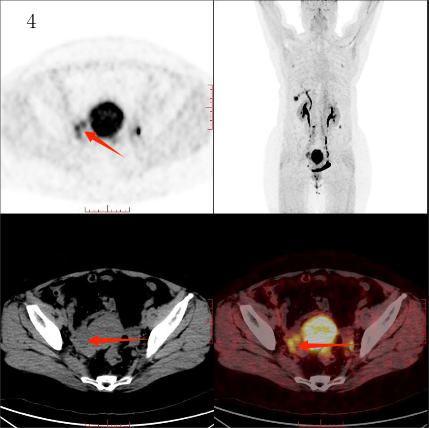 FAPI-PET/CT：精准捕捉腹膜转移癌的“神探”医药新闻-ByDrug-一站式医药资源共享中心-医药魔方