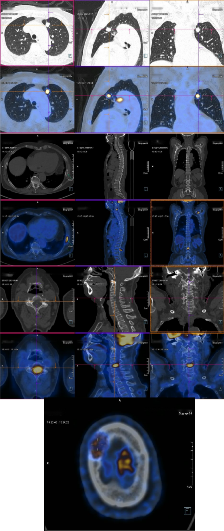 三线重启挑战达拉非尼联合曲美替尼治疗BRAF突变晚期肺腺癌，PFS超20个月！医药新闻-ByDrug-一站式医药资源共享中心-医药魔方