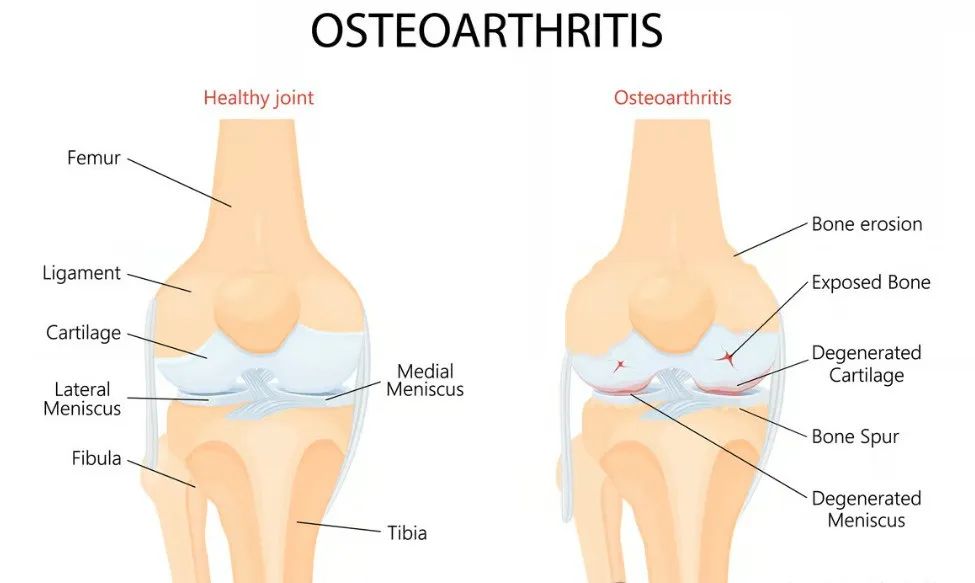 新型细胞疗法治疗膝骨关节炎，75%显著改善，效果长达12个月医药新闻-ByDrug-一站式医药资源共享中心-医药魔方