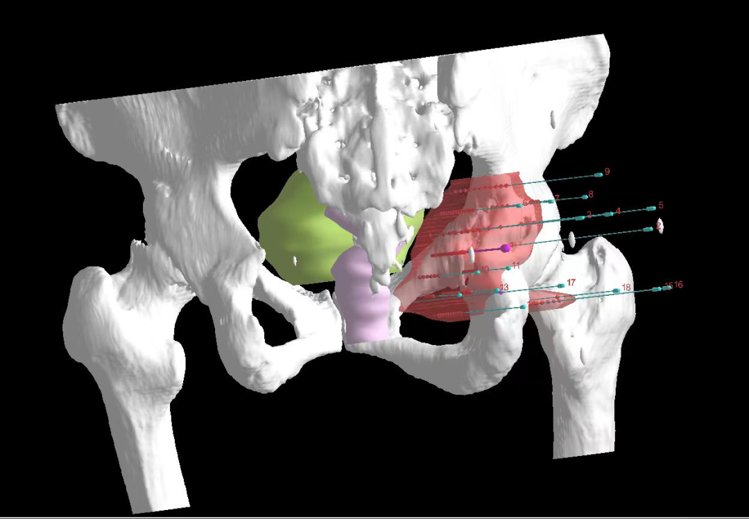 医疗案例 | 3D新技术让患者重获行走的希望！妇科放疗联合麻醉治疗转移性宫颈癌医药新闻-ByDrug-一站式医药资源共享中心-医药魔方