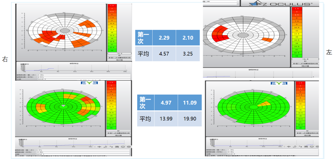 【光热脉动真实世界】光热脉动治疗3例典型MGD病例临床启示医药新闻-ByDrug-一站式医药资源共享中心-医药魔方