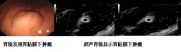 【特色技术】“镜”显神通——内镜全层切除术（EFTR）治疗胃固有肌层肿瘤医药新闻-ByDrug-一站式医药资源共享中心-医药魔方