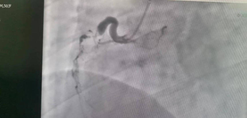 活心丸（浓缩丸）治疗病例之102—急性心肌梗死PTCA术后胸闷的心功能不全男性患者医药新闻-ByDrug-一站式医药资源共享中心-医药魔方