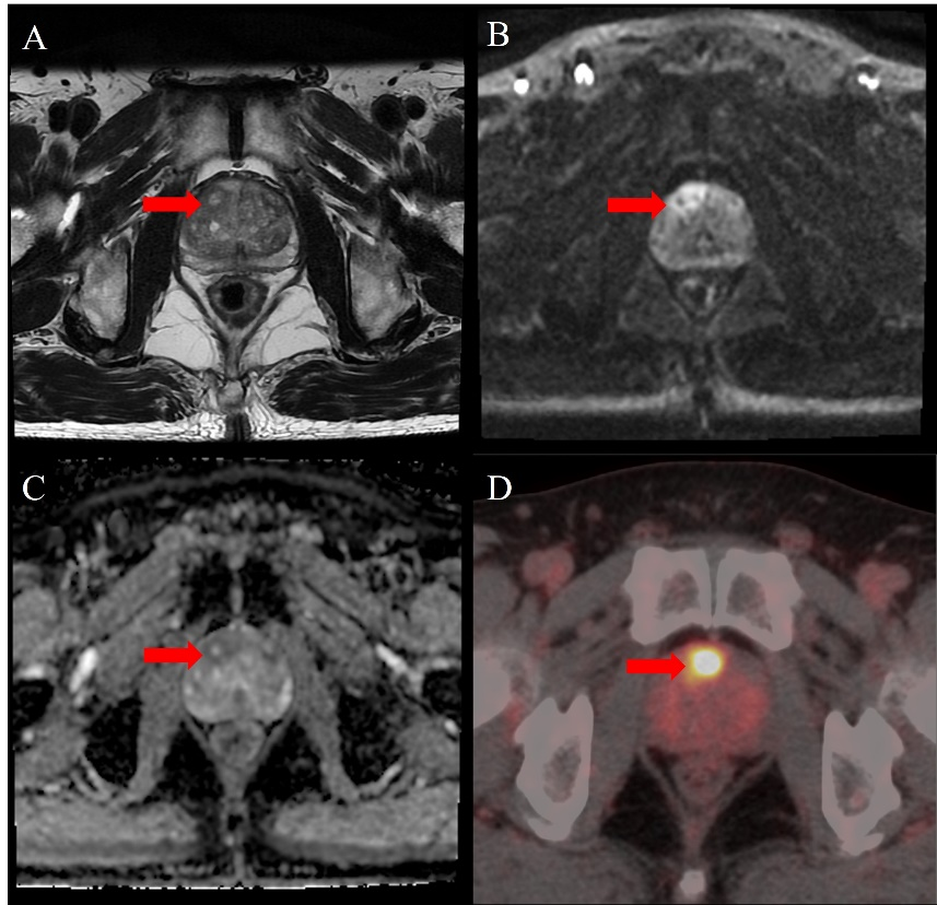 特异性诊断前列腺癌新 “雷达”——PSMA PET显像医药新闻-ByDrug-一站式医药资源共享中心-医药魔方