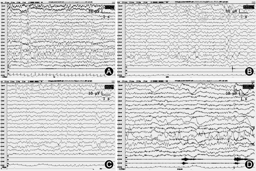 【临床研究】HPDL双等位基因致神经发育障碍伴进行性痉挛和脑白质异常的临床特点与基因分析医药新闻-ByDrug-一站式医药资源共享中心-医药魔方