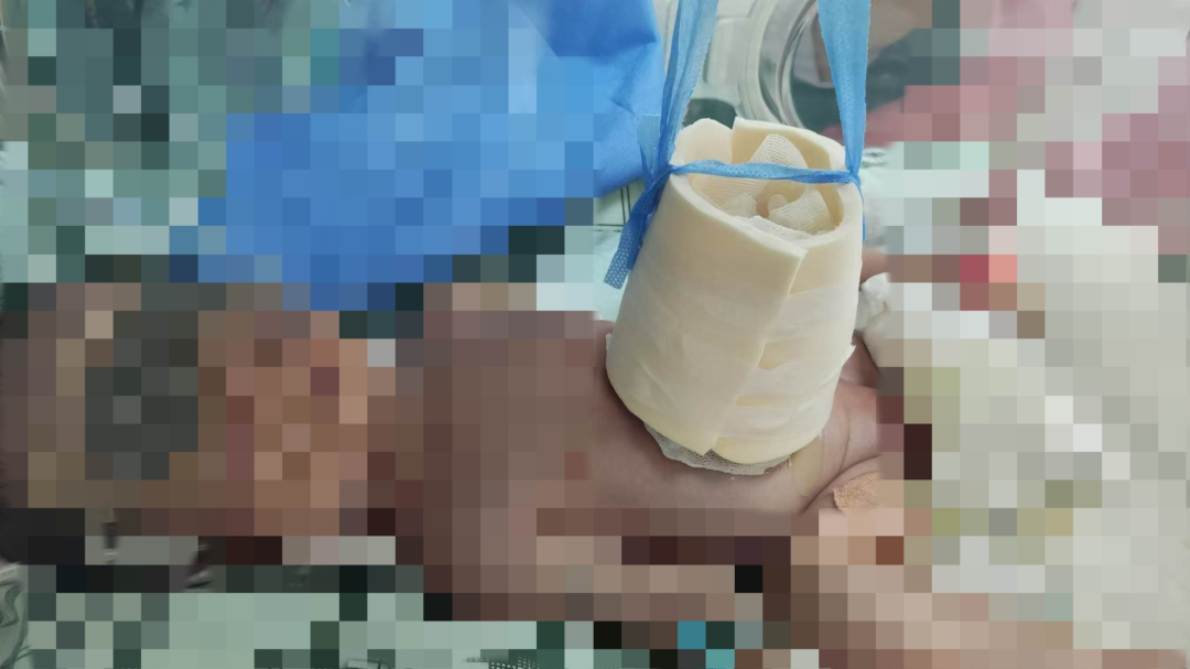 我院小儿普外科协同MDT团队成功救治一例巨大脐膨出患儿医药新闻-ByDrug-一站式医药资源共享中心-医药魔方