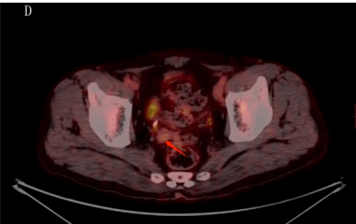FAPI-PET/CT：精准捕捉腹膜转移癌的“神探”医药新闻-ByDrug-一站式医药资源共享中心-医药魔方