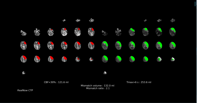 【参股公司医未医疗】获批AI卒中NMPA三类证丨中国唯一在AD及卒中领域均获三类证的企业医药新闻-ByDrug-一站式医药资源共享中心-医药魔方